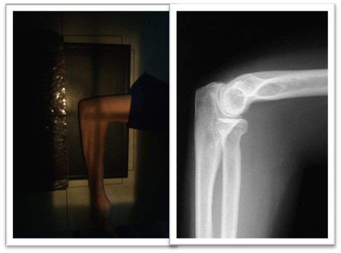 Guía multimedia en procesos de radiología: RADIOGRAFIA DE CODO EN ...