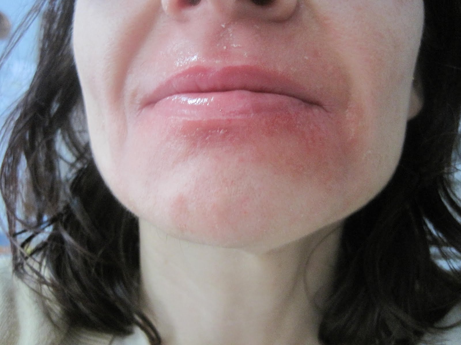 Living and Learning: Final Stages of Healing the Skin