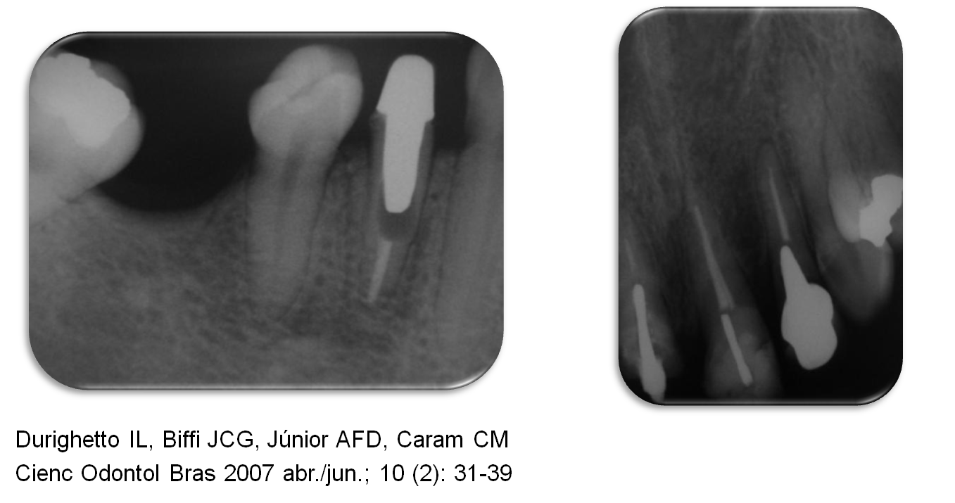 Odontologia: Retentores Intra-radiculares