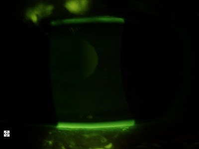 Sonoran Desert Eye Center: HERPES SIMPLEX DISCIFORM KERATITIS