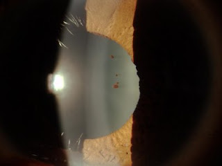 Sonoran Desert Eye Center: PIGMENT ON ANTERIOR CAPSULE