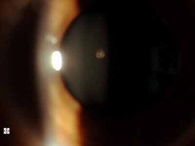 Sonoran Desert Eye Center: MITTENDORF'S DOT