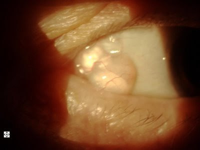 Retention Cyst