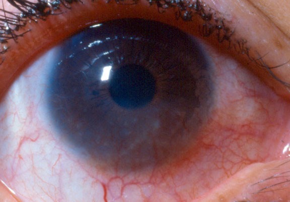 INTERESTING EYE NEWS & CLINICAL PEARLS: TOPICAL AVASTIN EFFECTIVE FOR ...