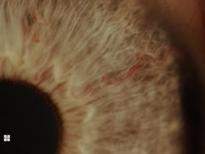 Sonoran Desert Eye Center: INTERESTING BLOOD VESSEL ON IRIS