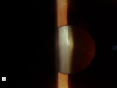 Sonoran Desert Eye Center: Cortical Spoking Cataracts