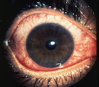 INTERESTING EYE NEWS & CLINICAL PEARLS: OCULAR MANIFESTATIONS OF SYPHILLIS