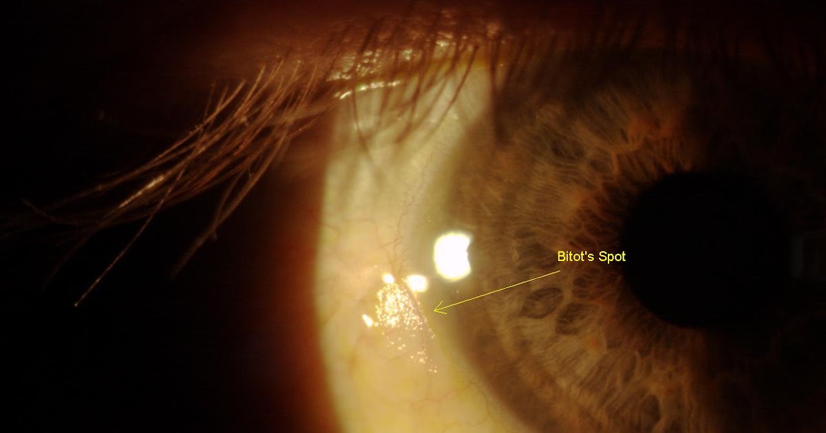 Sonoran Desert Eye Center: Vitamin A Deficiency