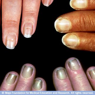 Nails and Health:What Your Nails Can Tell You