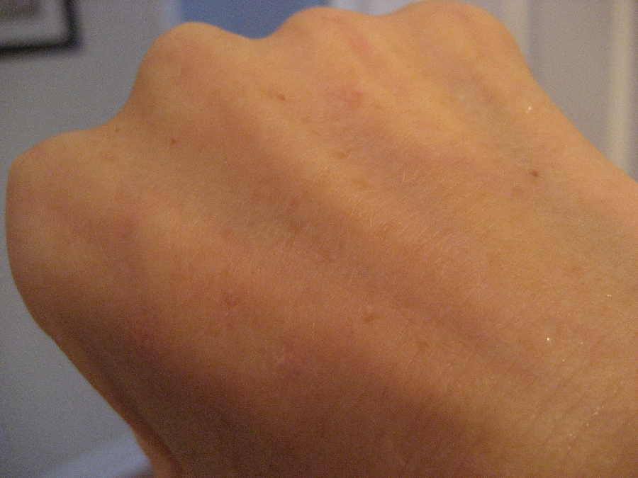 Chemical Peels for Acne and Anti Aging: Spot treatment for hands - day 5
