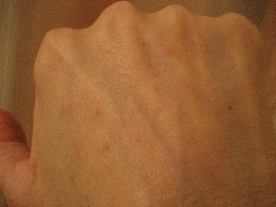 Chemical Peels for Acne and Anti Aging: Spot treatment for hands ...