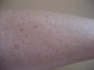 Chemical Peels for Acne and Anti Aging: TCA 50% Chemical peel - before ...