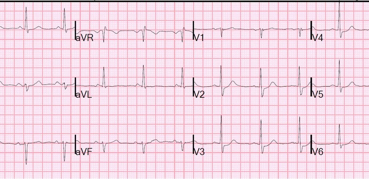 Dr. Smith's ECG Blog: ST depression V2-V4: Posterior leads, resolution ...