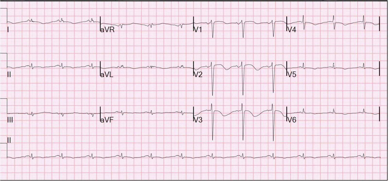 Dr Smiths Ecg Blog Takotsubo Stress Cardiomyopathy With Echocardiogram