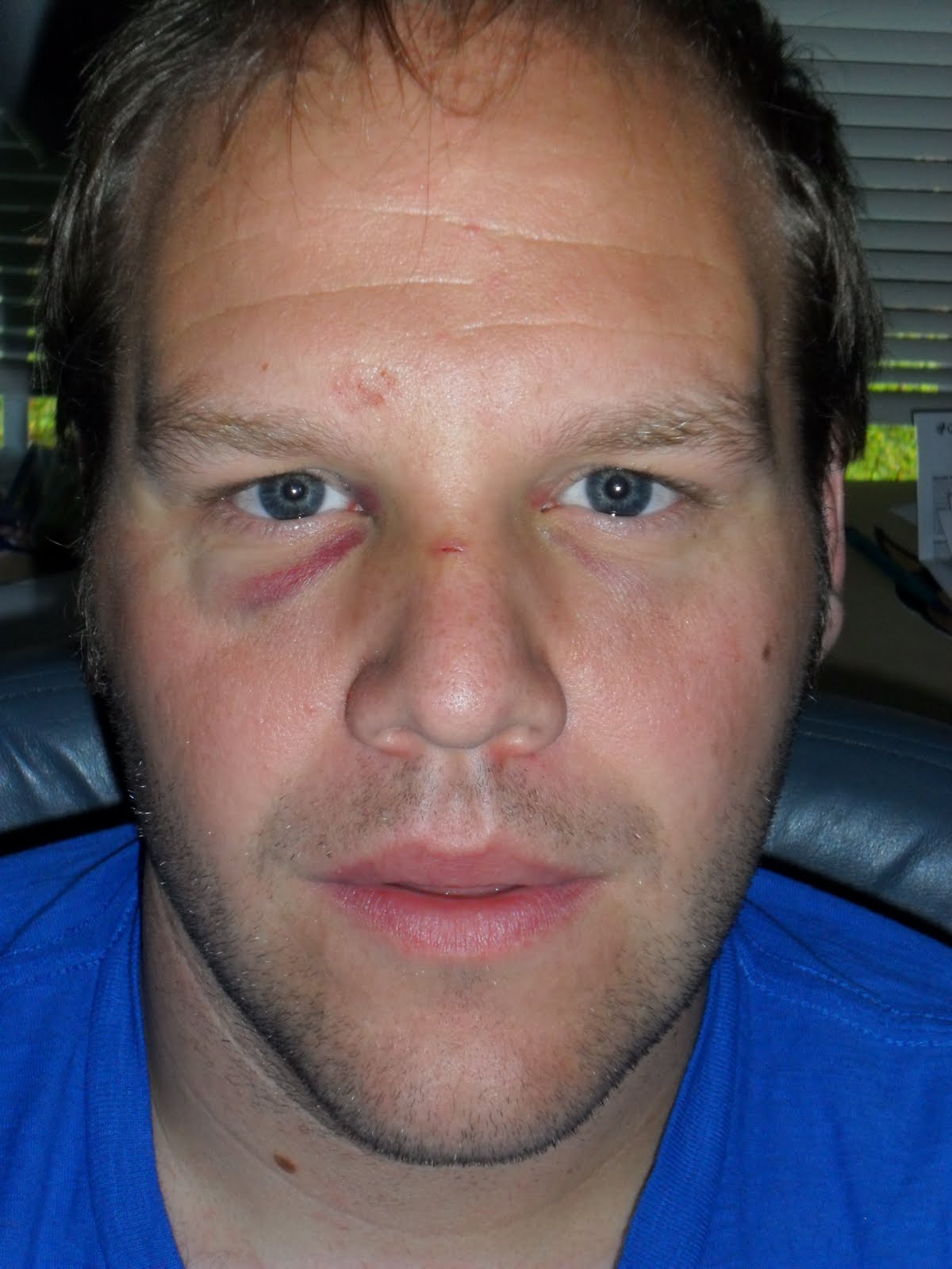 Nathan & Becca Mortensen: That time Nathan got hit in the face...