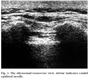 ANAESTHESIA TODAY: CAUDAL EPIDURAL BLOCK, A REVIEW.
