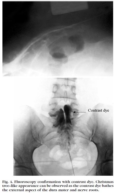ANAESTHESIA TODAY: CAUDAL EPIDURAL BLOCK, A REVIEW.