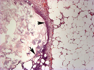 Necrosis grasa; Esteatonecrosis