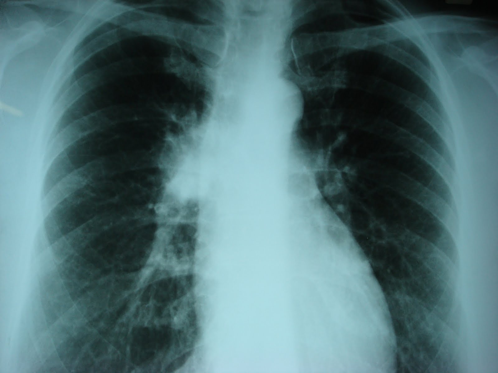 Cirurgia Torácica / Thoracic Surgery - Dr. Alexandre Avino: Right lower ...