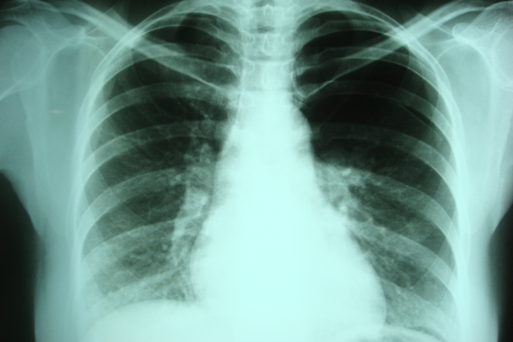 Cirurgia Torácica / Thoracic Surgery - Dr. Alexandre Avino ...