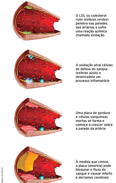 Navegando na Fisioterapia: O QUE È PLACA DE ATEROMA?