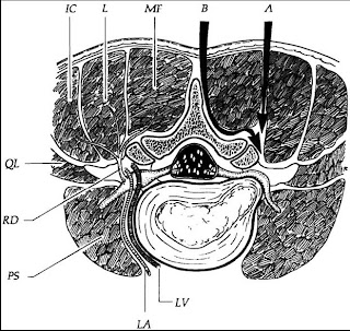 BONE PHANG: Describe the surgical approach to a far lateral disc hernia ...