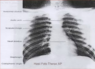 Teknik Pemeriksaan Radiografi Thorax Proyeksi PA - Seputar Kesehatan