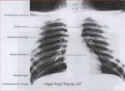 TEKNIK RADIOGRAFI THORAX - Radiografer