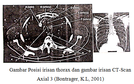 LAMPIRAN. Citra pertama yang diperoleh dari CT-scan Thorax adalah ...