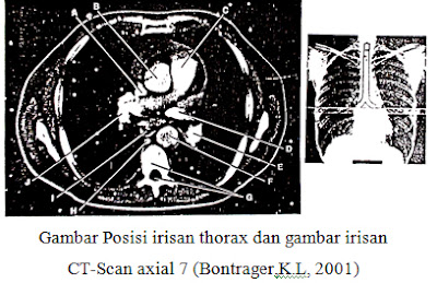 RADIOGRAFER WORLD: Teknik Pemeriksaan CT-Scan Thorax