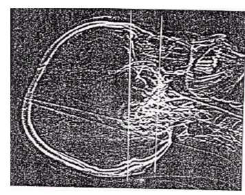 Teknik Pemeriksaan CT-Scan Mastoid ~ Catatan Radiograf