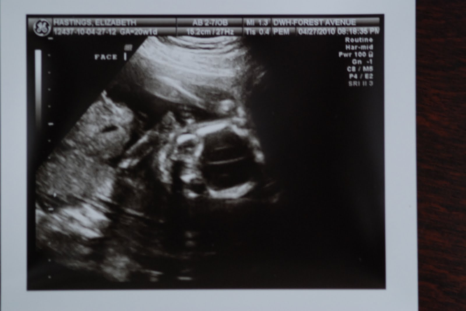Letters to Liam: 20-Week Ultrasound Pictures