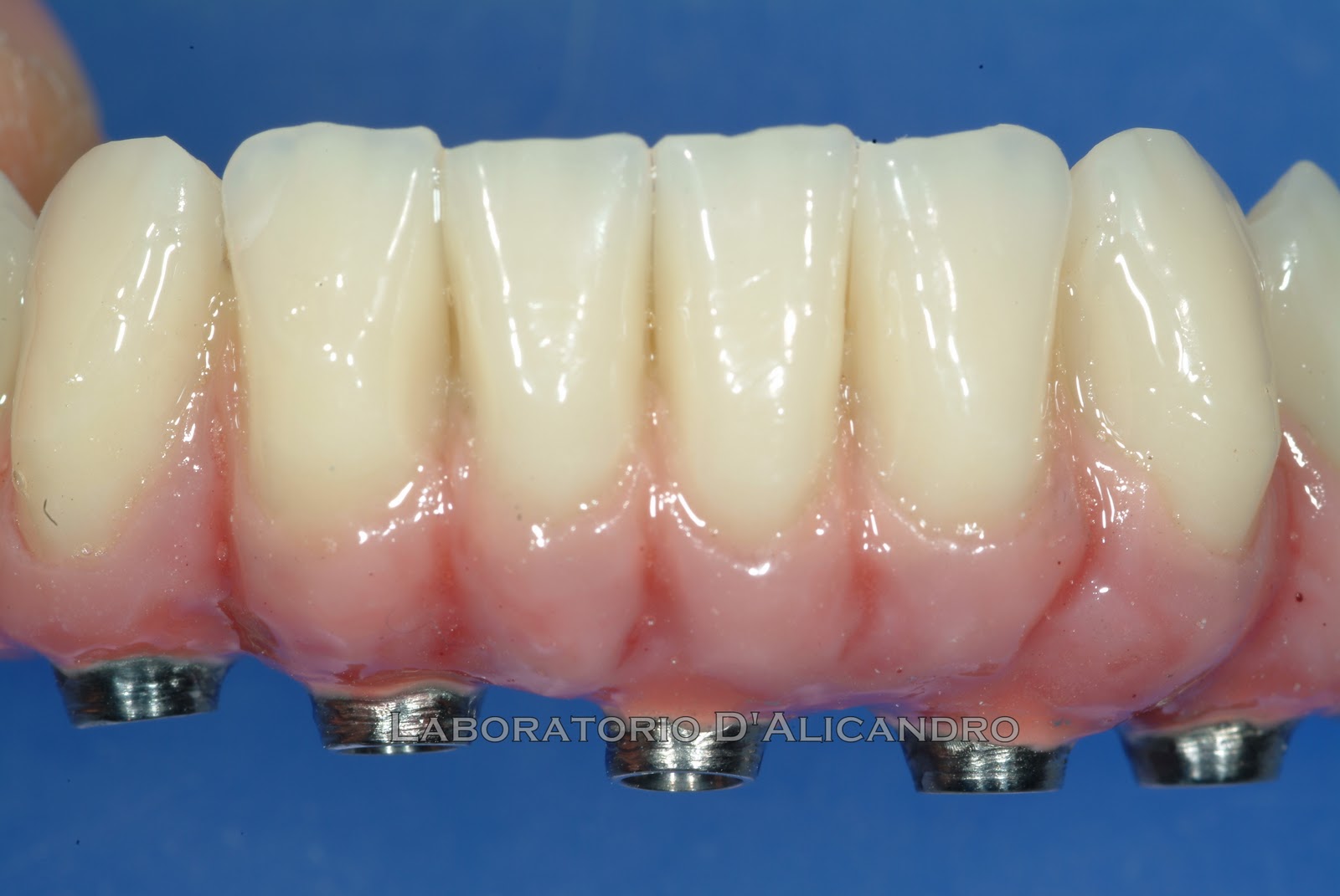 Laboratorio odontotecnico Tonino D'Alicandro: Toronto Bridge