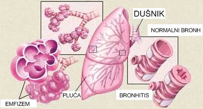 Prirodom do Zdravlja: Liječenje Bronhitisa