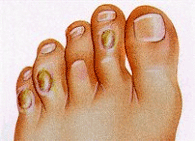 Prirodom do Zdravlja: Plikovi - Žuljevi