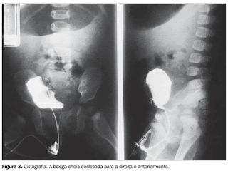 APRENDIENDO: CISTOGRAFIA O CISTOGRAMA