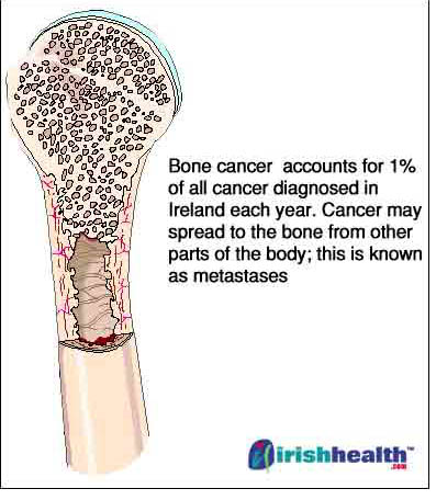 Disease Information Directory: BONE CANCER