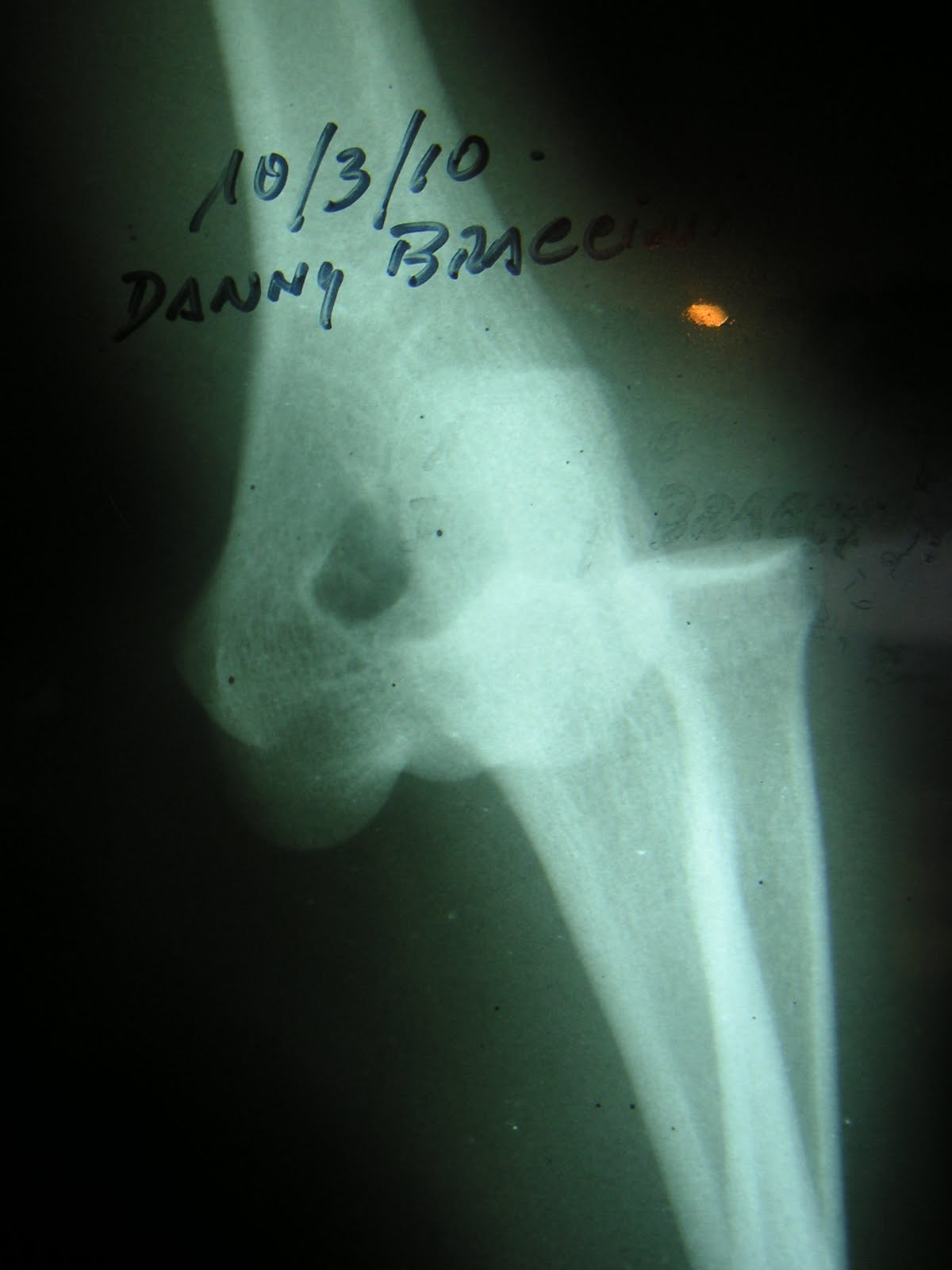 Orthophaedic and Traumatology Surgery.: POLITRAUMATIZADO SEVERO ...