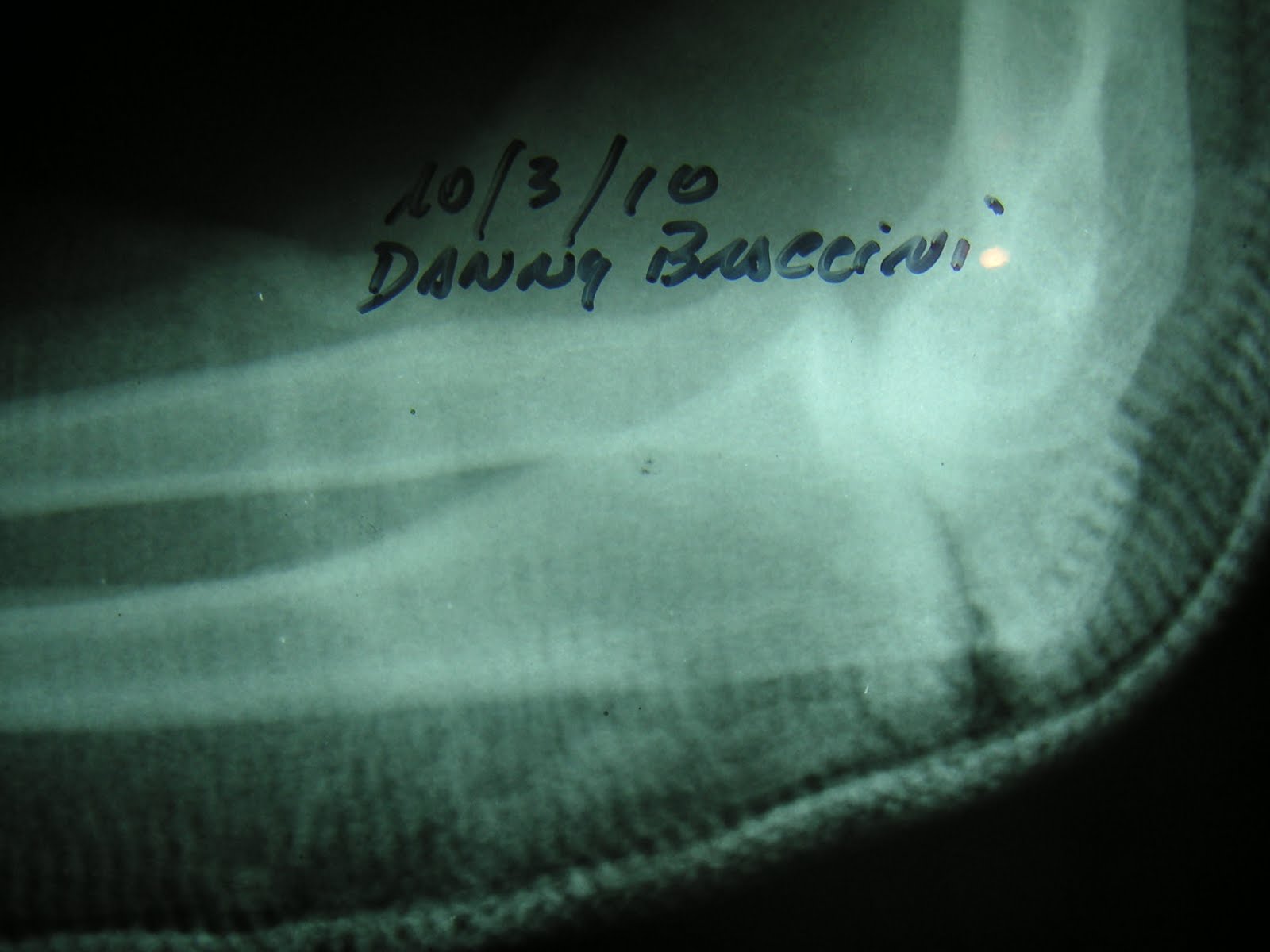 Orthophaedic and Traumatology Surgery.: POLITRAUMATIZADO SEVERO ...