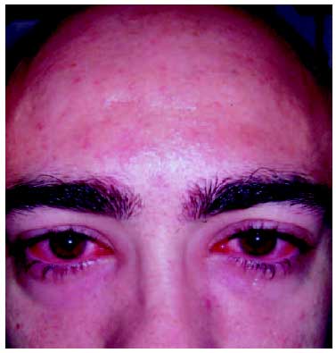 DIAGNÓSTICO DEL SINDROME DE REITER-TODO SOBRE SALUD Y ENFERMEDADES ...