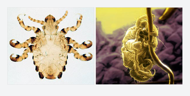 Causas y factores de riesgo de la ladilla o piojo pubico-TODO SOBRE ...