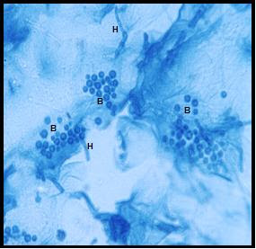 ATLAS DE MICOLOGÍA MÉDICA: 3. PITIRIASIS VERSICOLOR