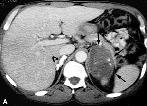 RadiologySpirit: adrenal tuberculosis