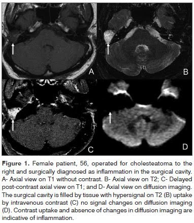 RadiologySpirit: Temporal bone infection