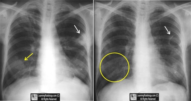 RadiologySpirit: Wegeners granulomatosis