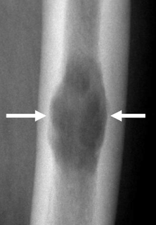 RadiologySpirit: Approach to bone lesions=figures and tables