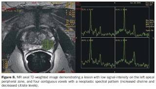 RadiologySpirit: MRI OF PROSTATE