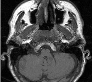 RadiologySpirit: Thornwaldt Cyst
