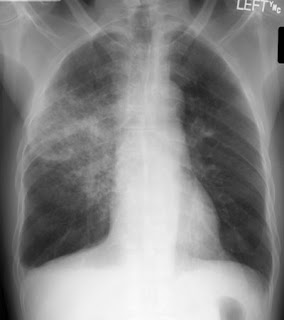 RadiologySpirit: Pneumonia=Acute Pulmonary Infiltrate