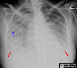 RadiologySpirit: Acute Pulmonary Edema= acute pulmonary infiltrate